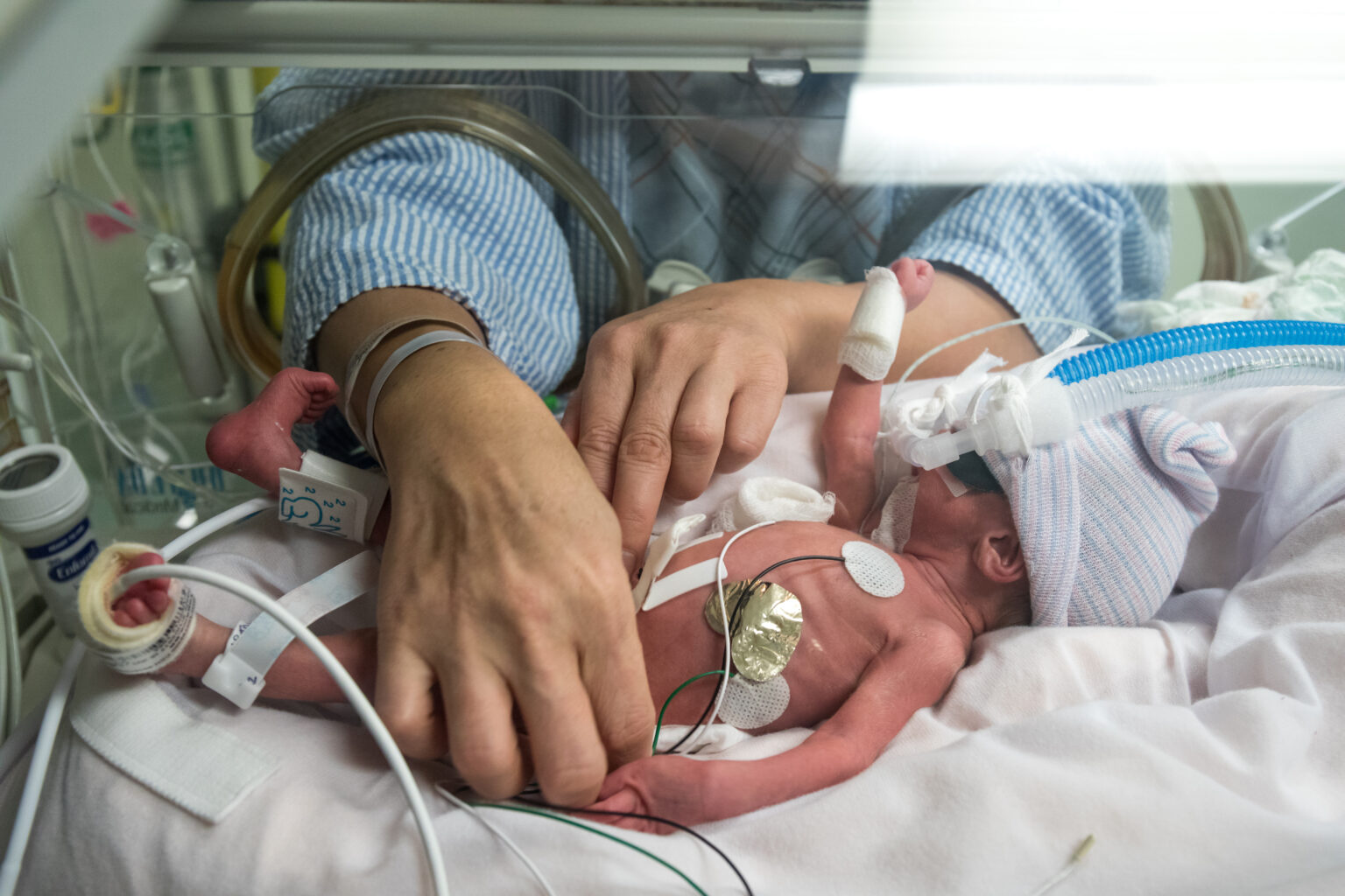 Early Prediction Of Newborn Chronic Lung Disease Is Urgently Needed For